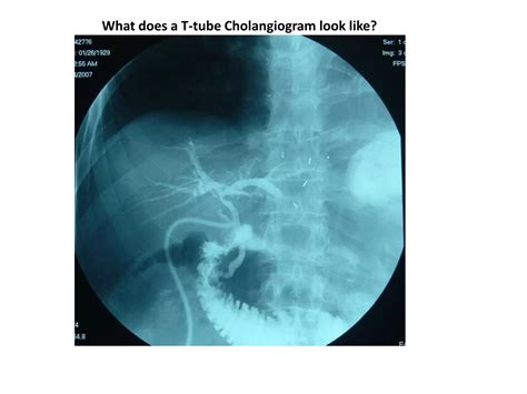 T Tube Cholangiogram Ppsx