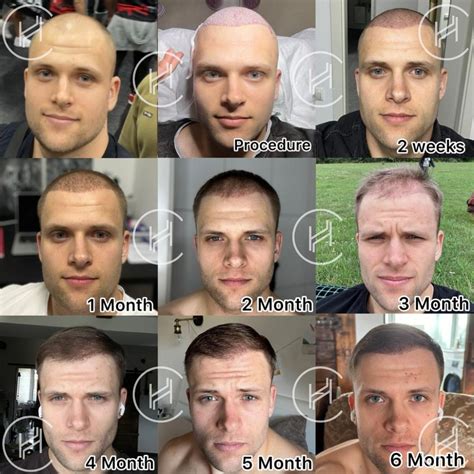 Can You Go Bald After Hair Transplant How To Stop It