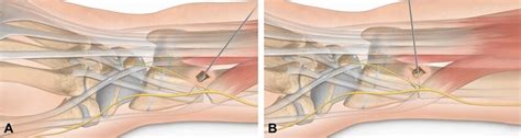 Distal Radius Fracture Kapandji Intrafocal Pinning Technique