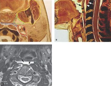 Retropharyngeal And Prevertebral Space Inflammatory Conditions Radiology Key