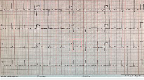 Electrocardiogram Of The Patient At The Time Of Admission With Download Scientific Diagram