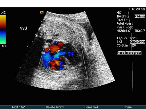 Ventricular Septal Defect Vsd Obstetrics And Gynecology