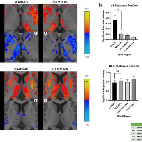 Positive And Negative Temporal Lobe Connectivity In Healthy Controls