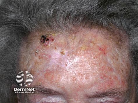 Cutaneous Squamous Cell Carcinoma Images