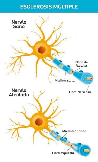 Esclerosis Multiple Causas