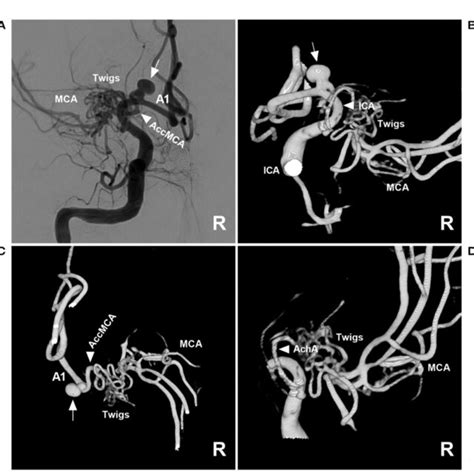 Figure Angioarchitecture Of Twig Like Mca A Two Dimensional Dsa Of Download Scientific