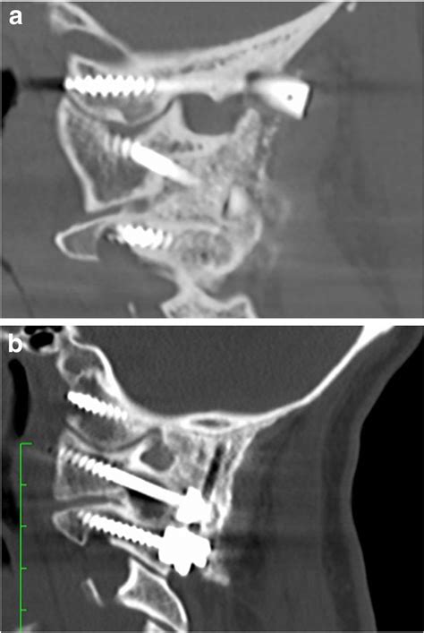 A Sagittal 2d Ct Showing Condylar Screw In Hypoplastic Condyle B Download Scientific Diagram