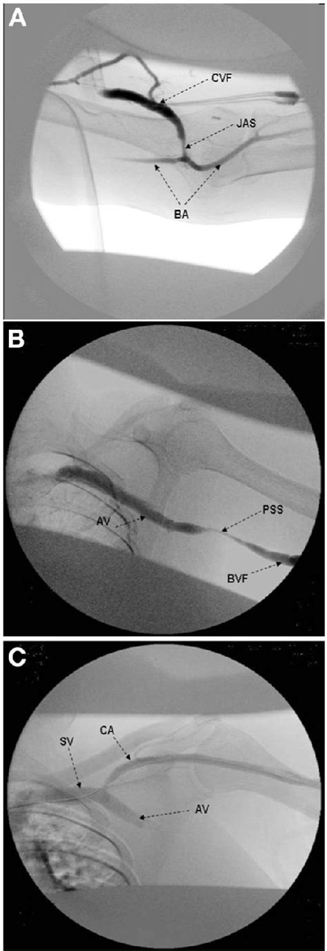 Juxta Arterial Mesenteric Lymph Node Semantic Scholar