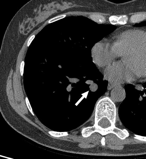 Bronchial Carcinoid Shown As Dense Nodule At The Lower