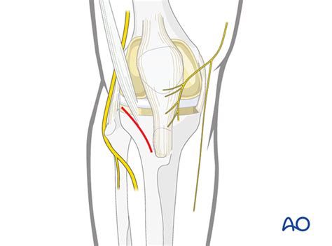 Mio Anterolateral Approach To The Proximal Tibia