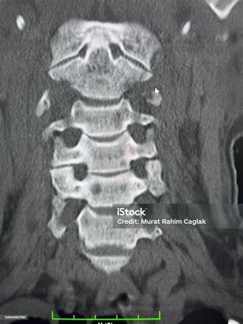 Computed Tomography Image Of Patient With Second Cervical Bone Fracture