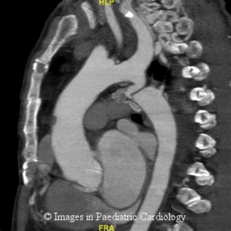 Tte Spectral Doppler On Flow Pattern In The Abdominal Aorta Showing Download Scientific Diagram