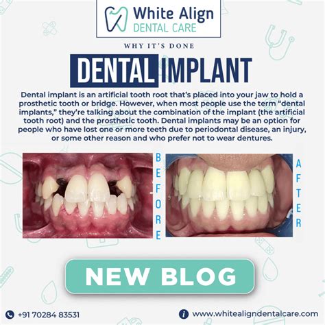 Teeth Scaling And Polishing Benefits Procedure And Aftercare
