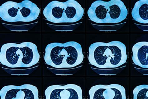 Ct Low Dose Lung Cancer Screening Hudson Imaging