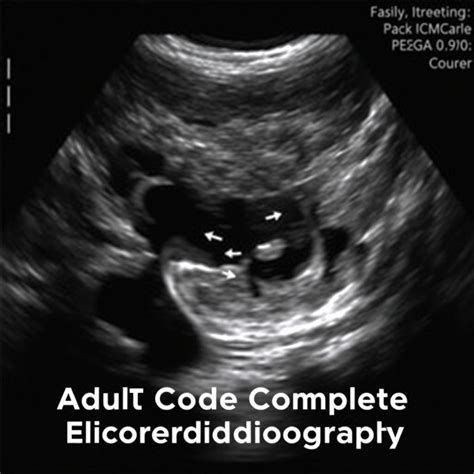 Cpt Code For Adult Complete Echocardiogram And Cost Of Amalgam Fillings