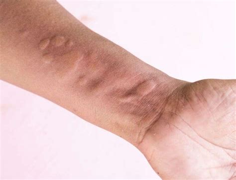 Urticaria What Is Urticaria