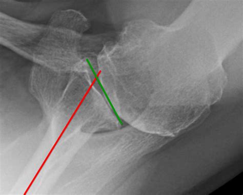 Uw Shoulder And Elbow Academy Measuring Glenoid Version And The Position Of The Humeral Head On
