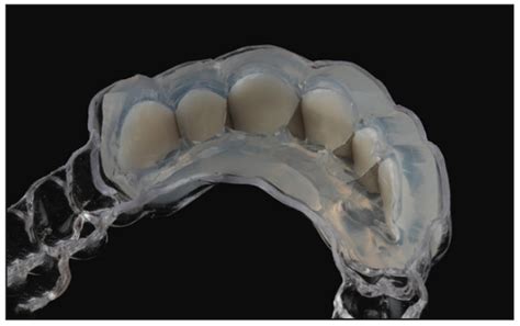 Efficient And Predictable Composite Smile Makeovers Dentistry Today