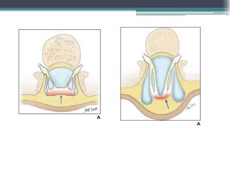 Imaging In Spinal Dysraphism Pptx