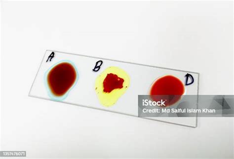 Photo Libre De Droit De Test Du Groupe Sanguin Et Du Facteur Rh Par La Méthode Dagglutination