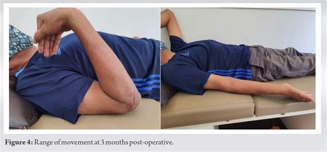 Complete Rupture Of Common Extensor Origin Of Elbow A Rare Case Report Management And Outcome