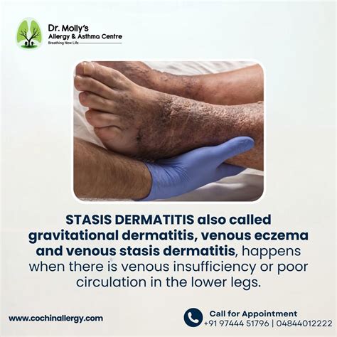 Dr Understanding Stasis Dermatitis 🩸 🔍 What Is Stasis Dermatitis