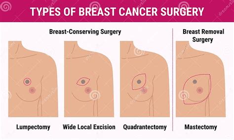 Types Of Breast Cancer Surgery Lumpectomy Quadrantectomy Mastectomy