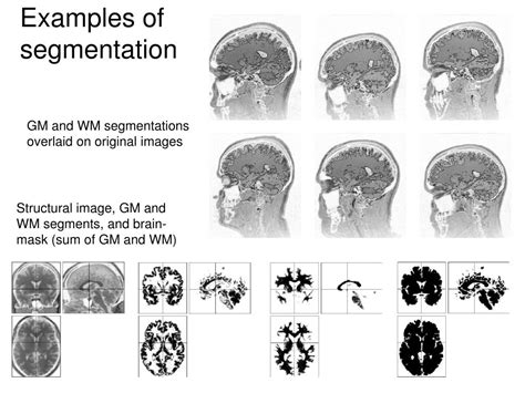 Ppt Voxel Based Morphometry With Unified Segmentation Powerpoint Presentation Id508607