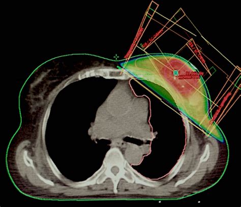 Simultaneous Integrated Boost In Once Weekly Hypofractionated Radiotherapy For Breast Cancer In