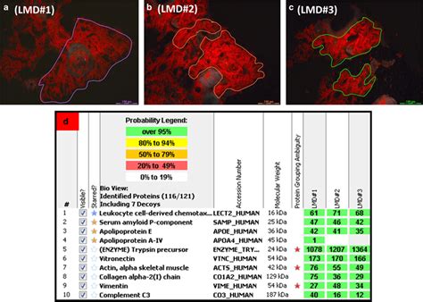 Laser Microdissection Mass Spectrometry In A Patient With Renal Alect2
