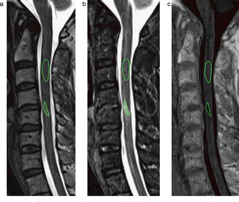 Ms Progression On Mri At Amy Hartzell Blog