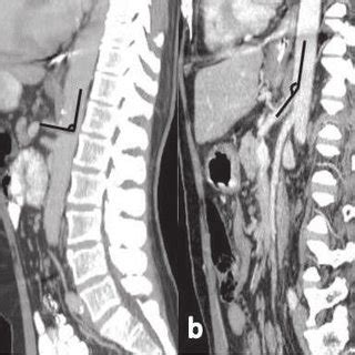 Selective Catheters A Berenstein Catheter B Cobra 1 Cateter C