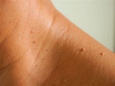 Fibroma Pêndulo Ou Fibroma Mole O Que é E Qual O Tratamento