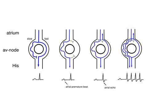 Filere Entrysvg Ecgpedia
