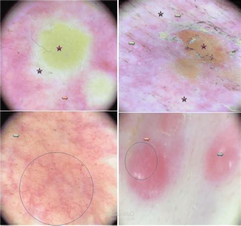 Detect Breast Canser مستقل