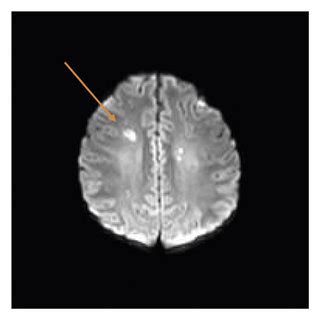 ADC Mapping With An Area Of Low Signal Intensity Left Image Orange Download Scientific Diagram