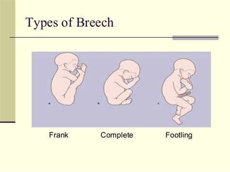 Frank Breech Presentation Fetal Presentation Breech Posterior