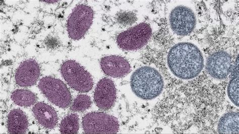 Texas Official Confirms First Death Of Person With Monkeypox