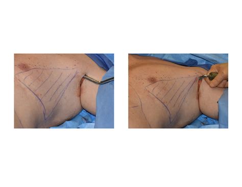 Surgical Techniques For Pectoral Implants Explore Plastic Surgery