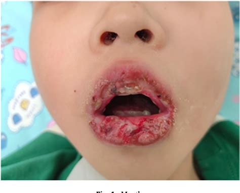 Figure 1 From Mycoplasma Pneumoniae Induced Rash And Mucositis Semantic Scholar