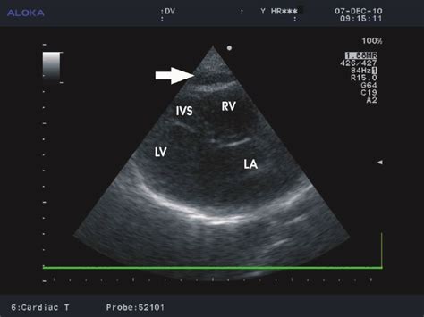 Transthoracic Echocardiogram In The Parasternal Long Axis View At The