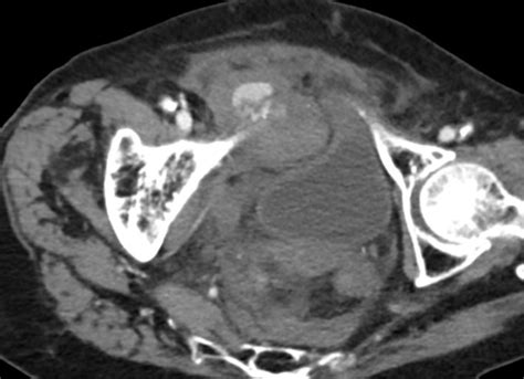 Ct Case 097 • Litfl • Ct Scan Interpretation