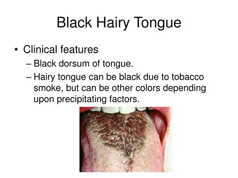Ppt Tobacco Related Lesions Oral Medicine Block Powerpoint