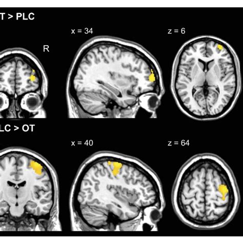 Statistical Map Of Oxytocin Ot Effects Compared To Placebo Plc In Download Scientific