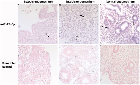 MiR 25 3p Expression In Ectopic Eutopic And Normal Endometrium The