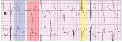 Pacemaker Rhythm Strips