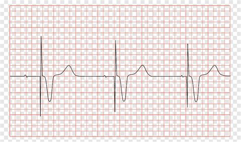 인공 심장 박동 조율기 심전도 심박 조율 증후군 다 초점 심방 빈맥 의학 심전도 기타 각도 Png Pngegg