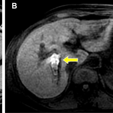 Ischemic Cholangitis With Fibrosis A 46 Year Male Status Download