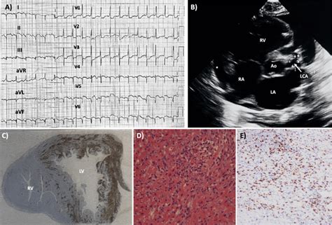 Enterovirus Acute Myocarditis A Ecg Revealed Sinus Rhythm Of 150 Download Scientific Diagram