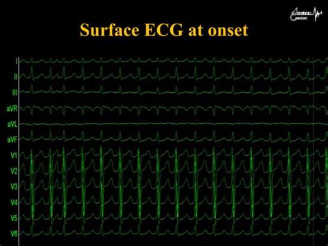Ablation Of Atypical Flutter Pptx